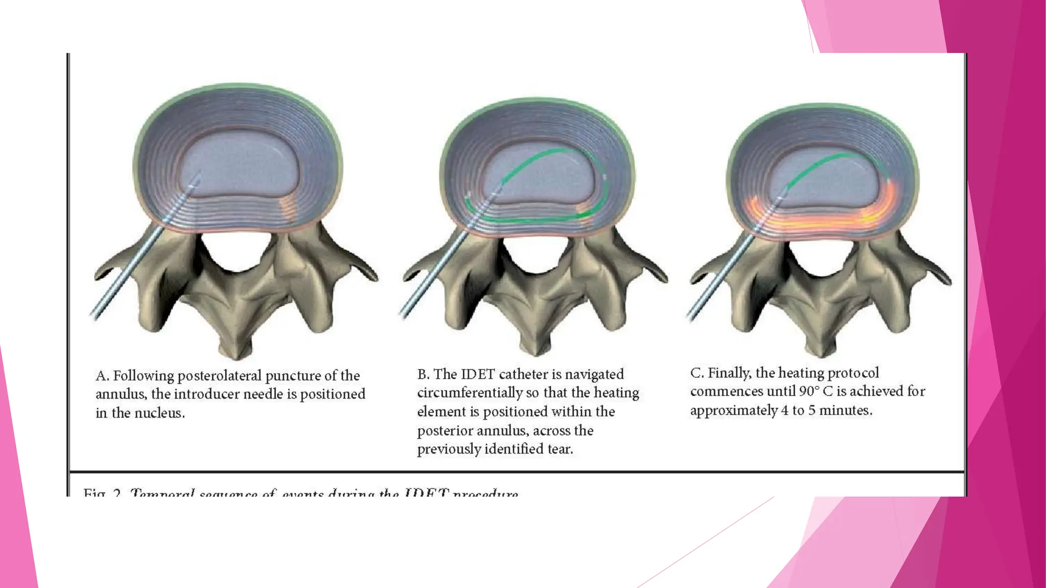 PPT ON INTERVERTEBRAL DISC PROLAPSE CLASS | PPTX