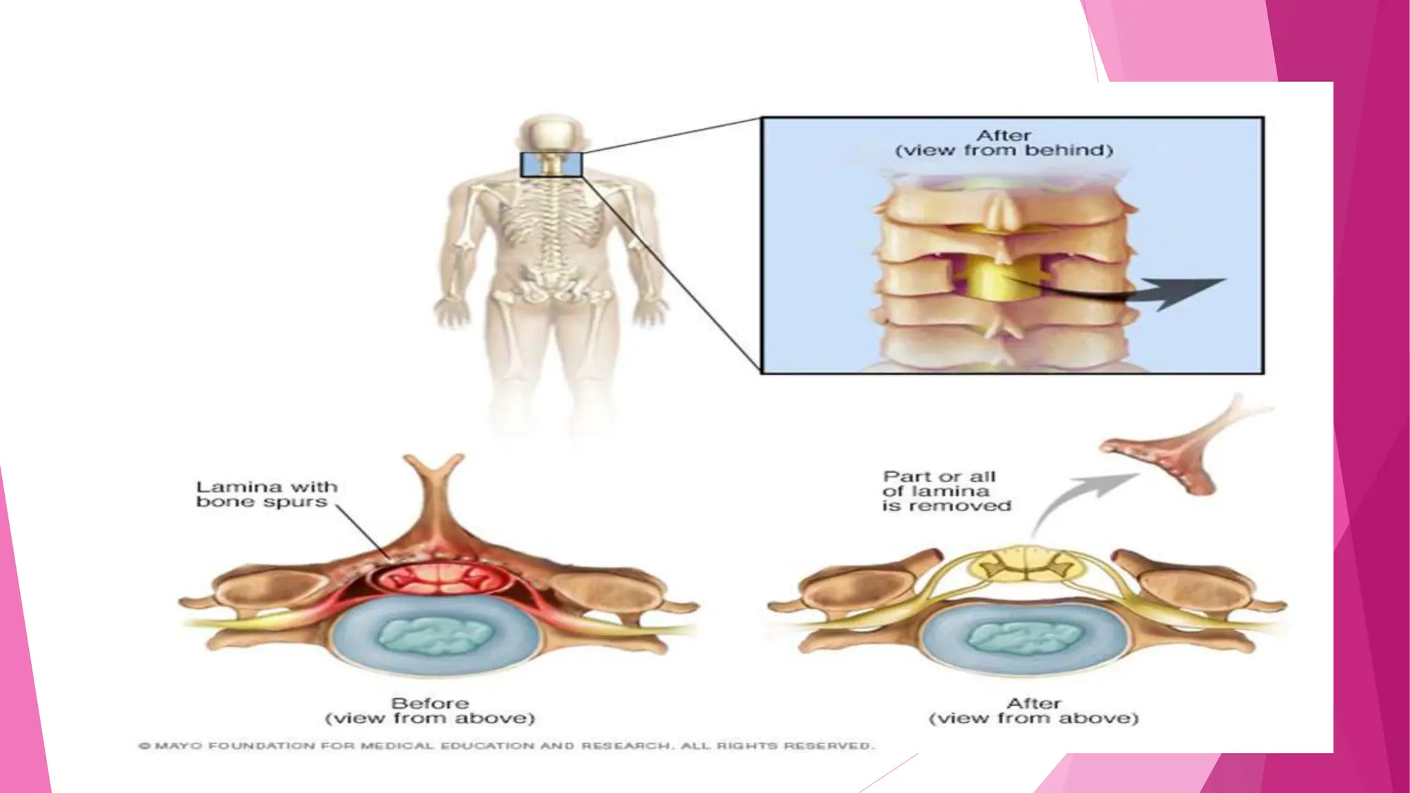 PPT ON INTERVERTEBRAL DISC PROLAPSE CLASS | PPTX