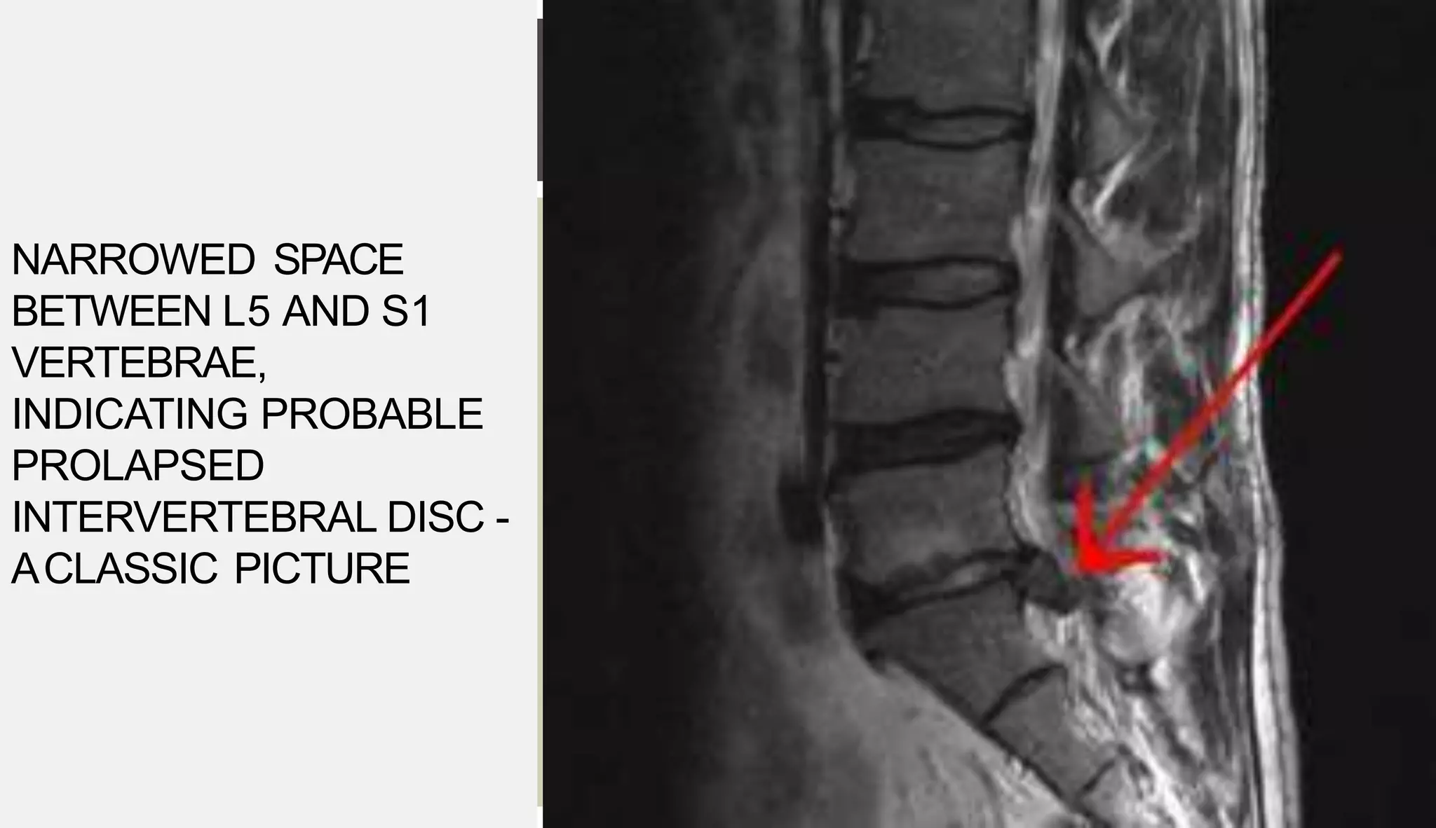 Intervertebraldiscprolapseivdp 171013100709-converted | PPTX | Bone and ...