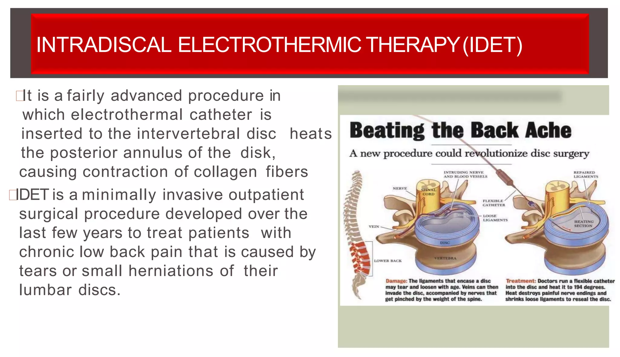 Intervertebraldiscprolapseivdp 171013100709-converted | PPTX