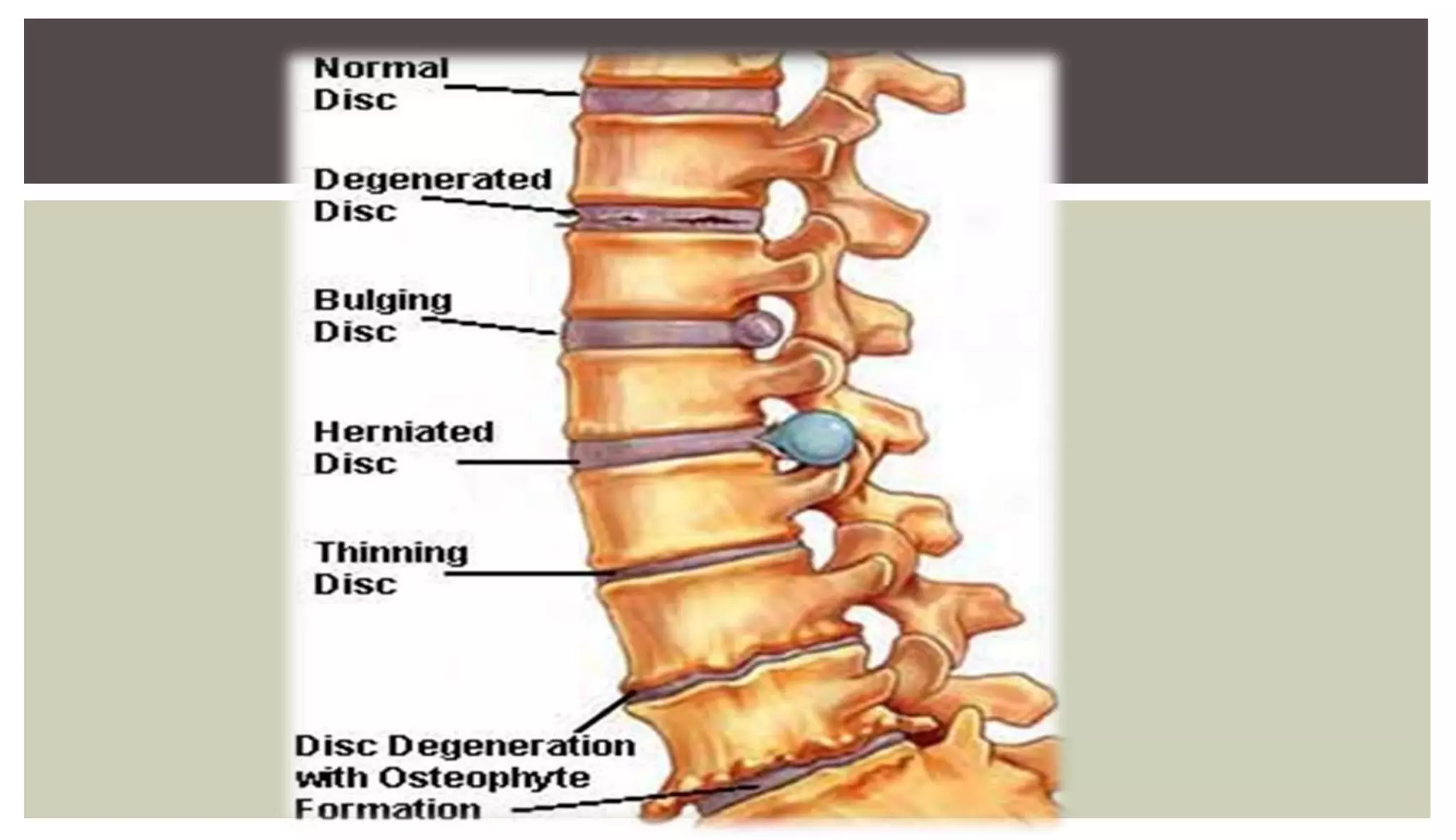 Intervertebral disc prolapse(ivdp) | PPTX