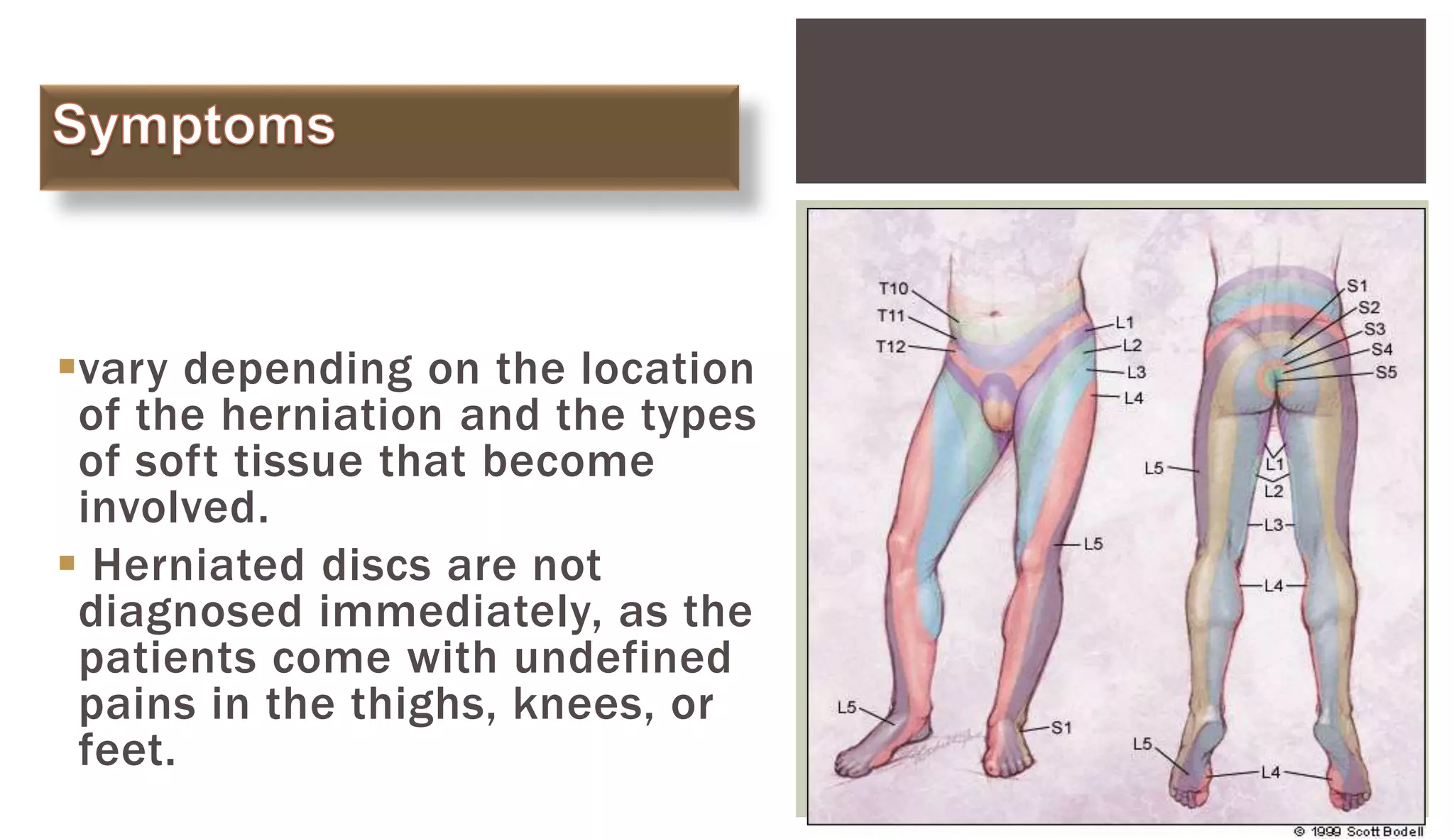 Intervertebral disc prolapse(ivdp) | PPTX