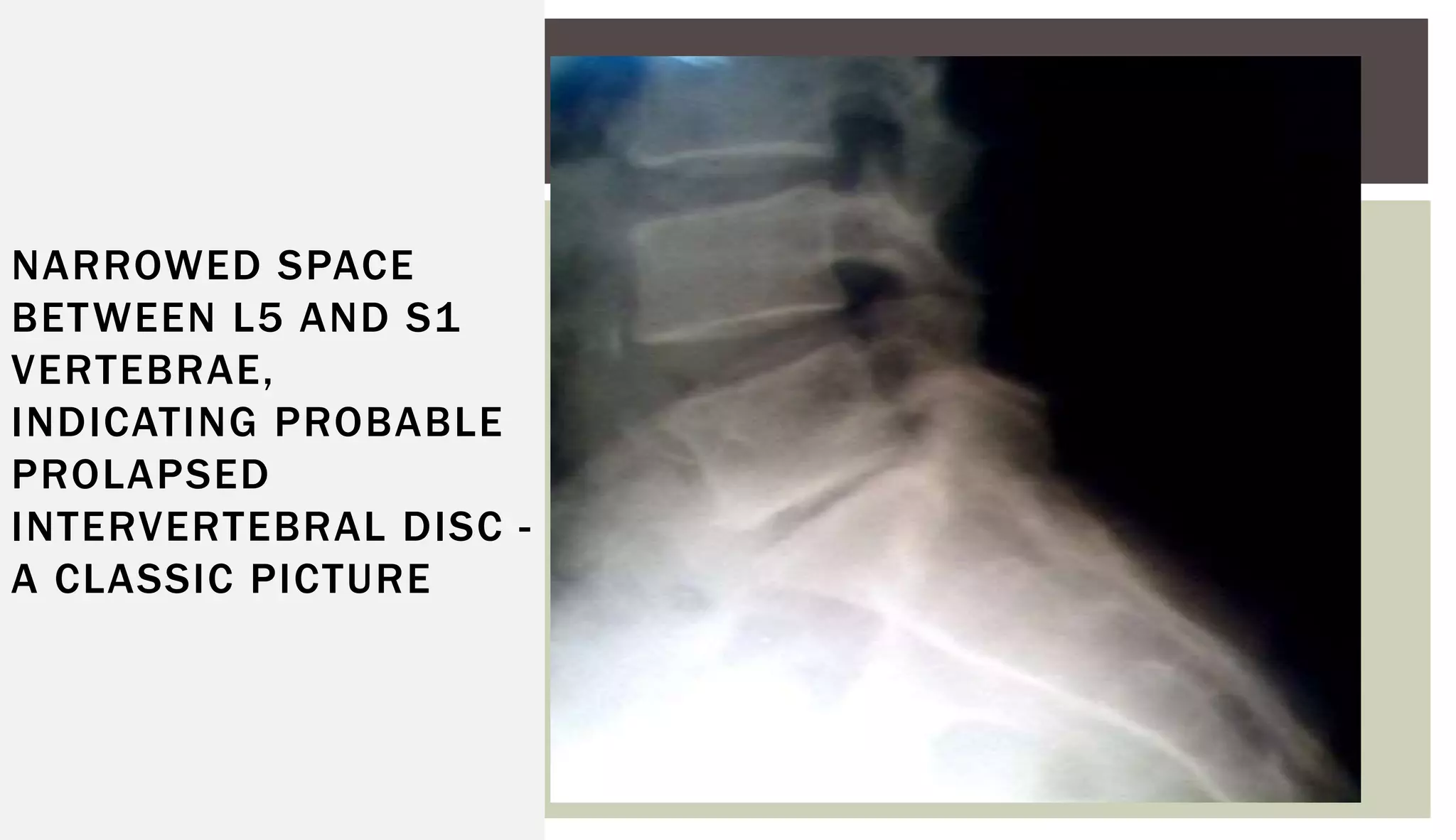 Intervertebral disc prolapse(ivdp) | PPTX