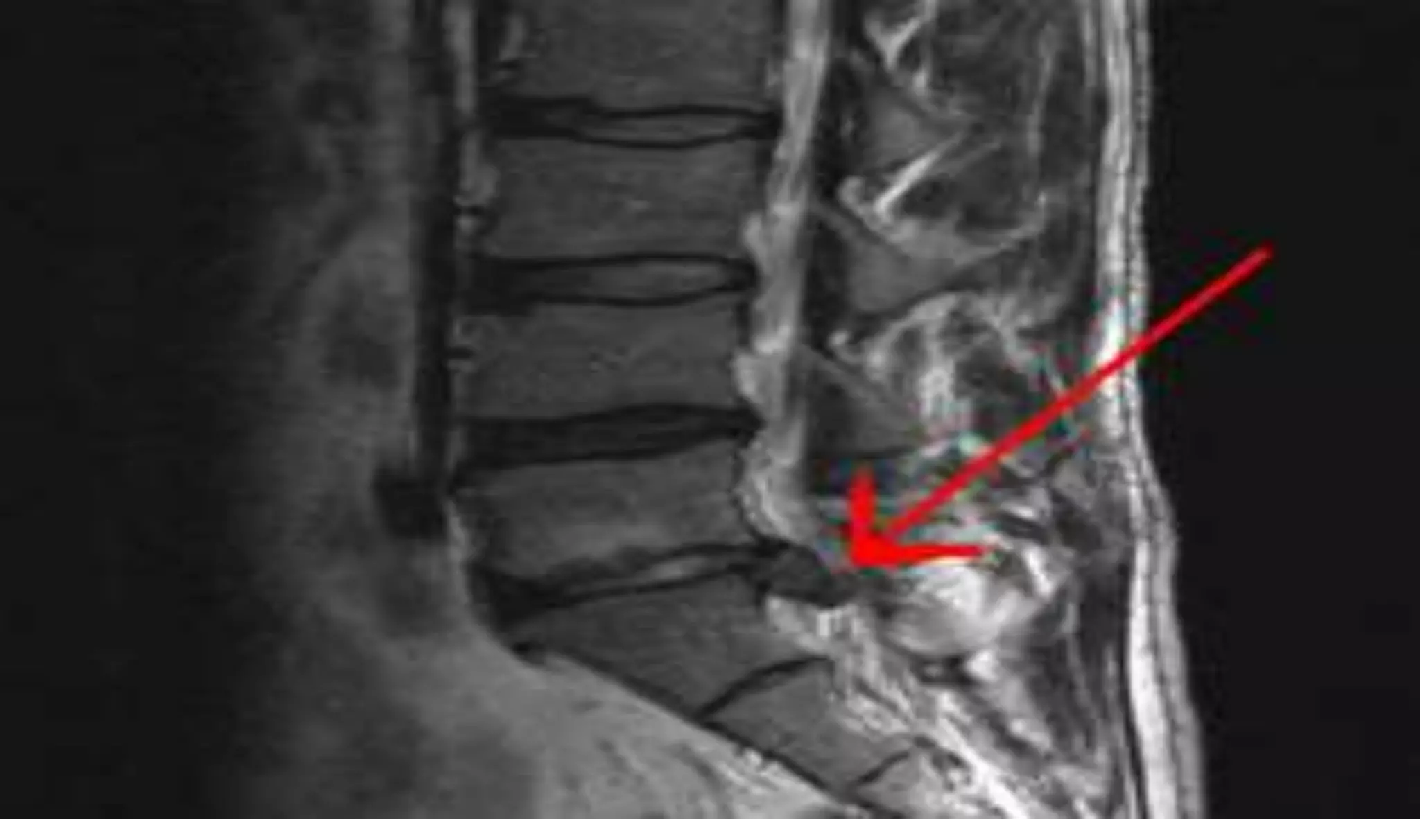 Intervertebral disc prolapse(ivdp) | PPTX
