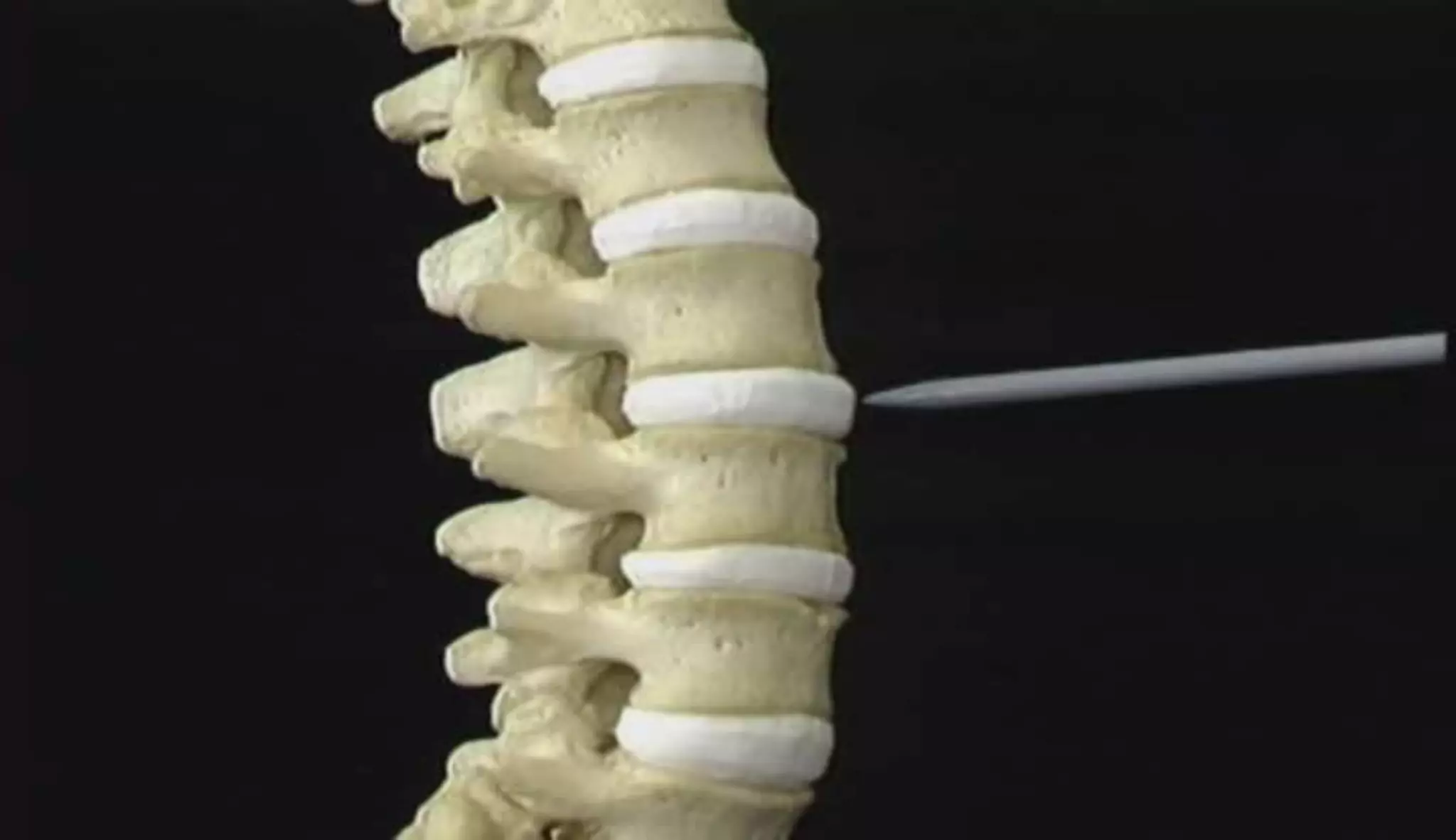 Intervertebral disc prolapse(ivdp) | PPTX