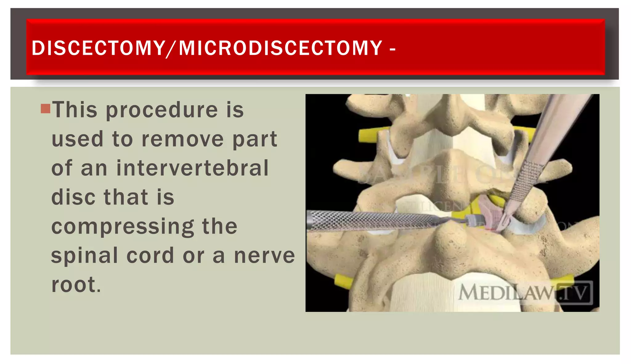 Intervertebral disc prolapse(ivdp) | PPTX