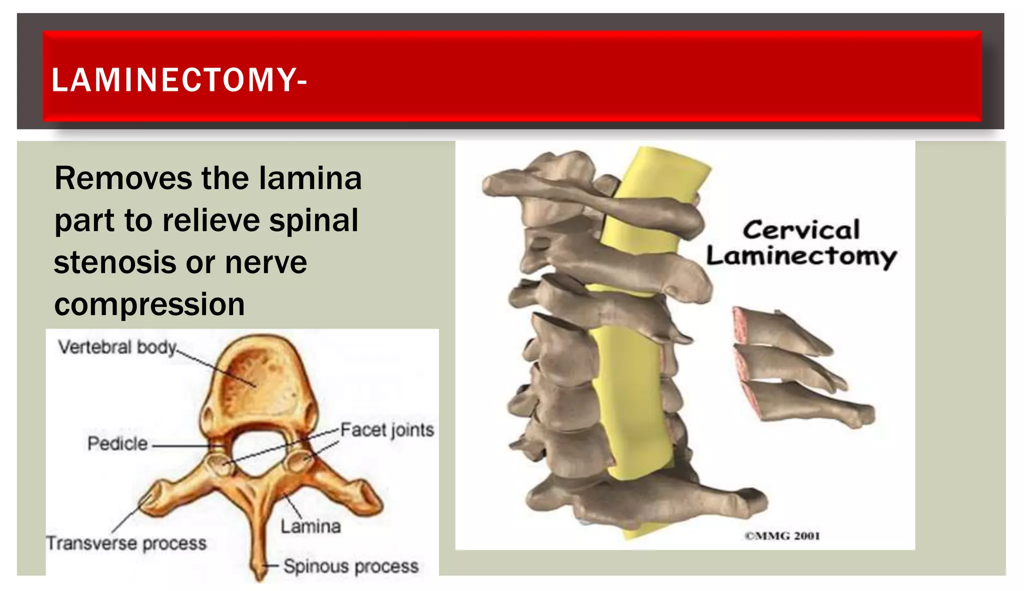 Intervertebral disc prolapse(ivdp) | PPTX