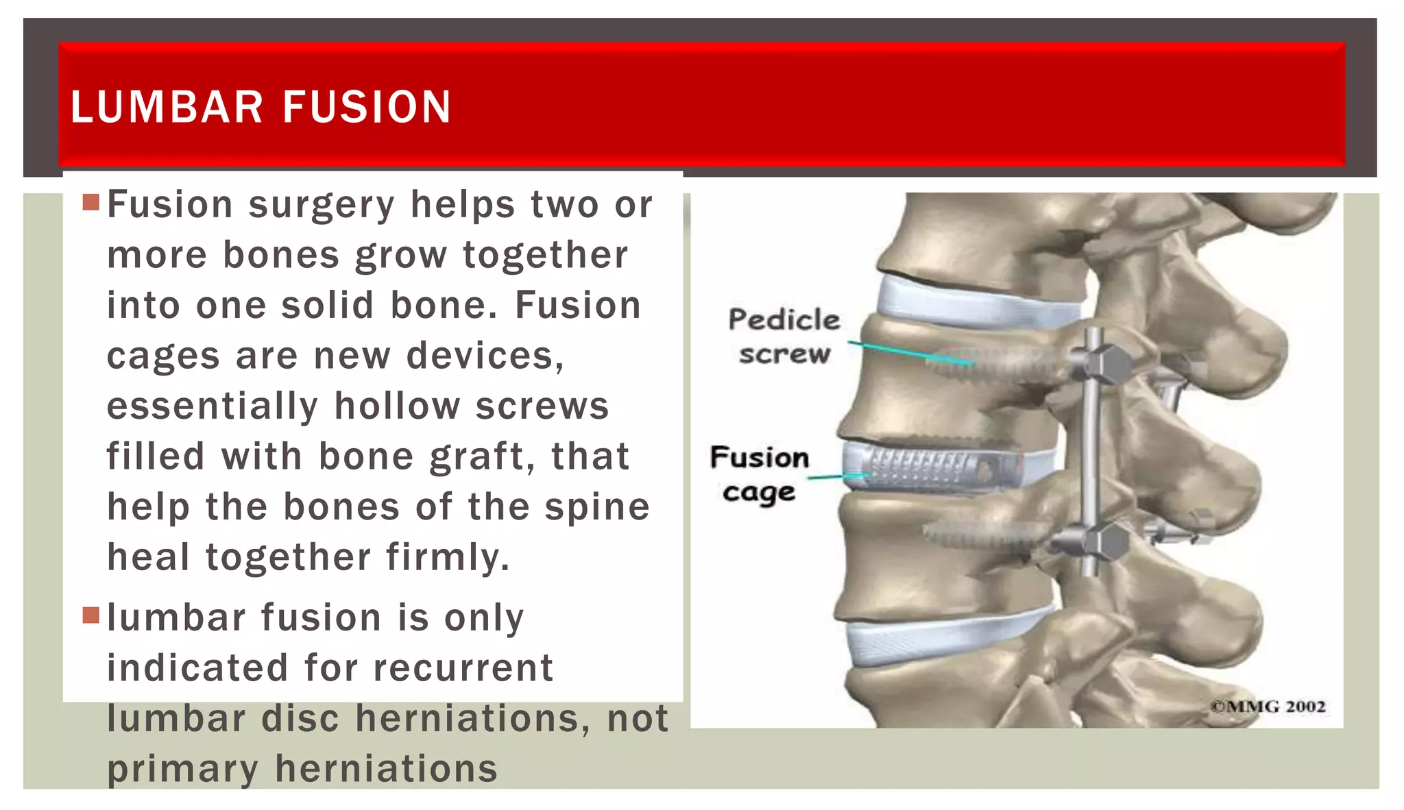 Intervertebral disc prolapse(ivdp) | PPTX