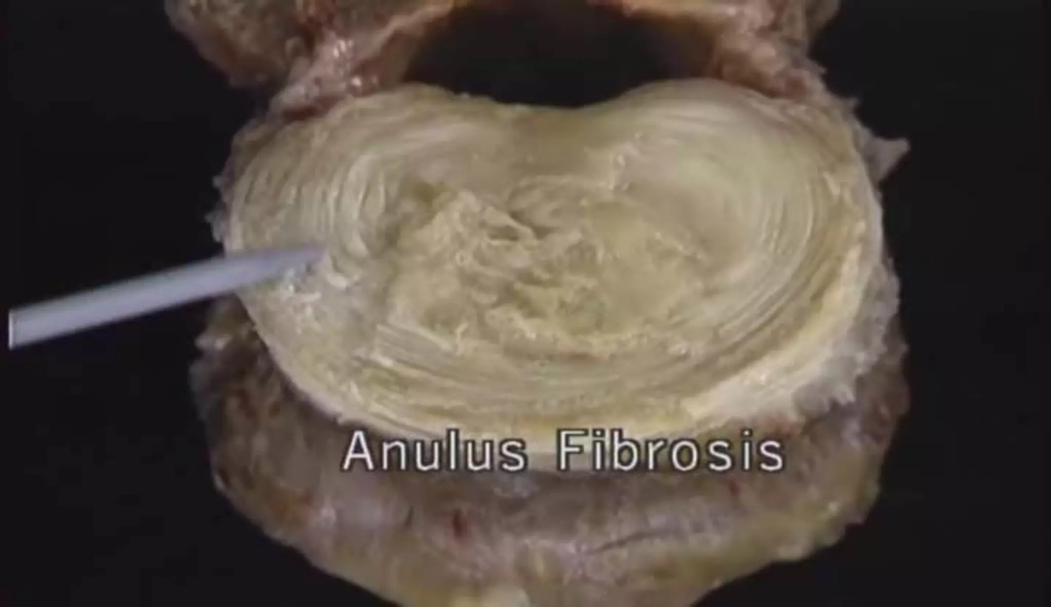 Intervertebral disc prolapse(ivdp) | PPTX
