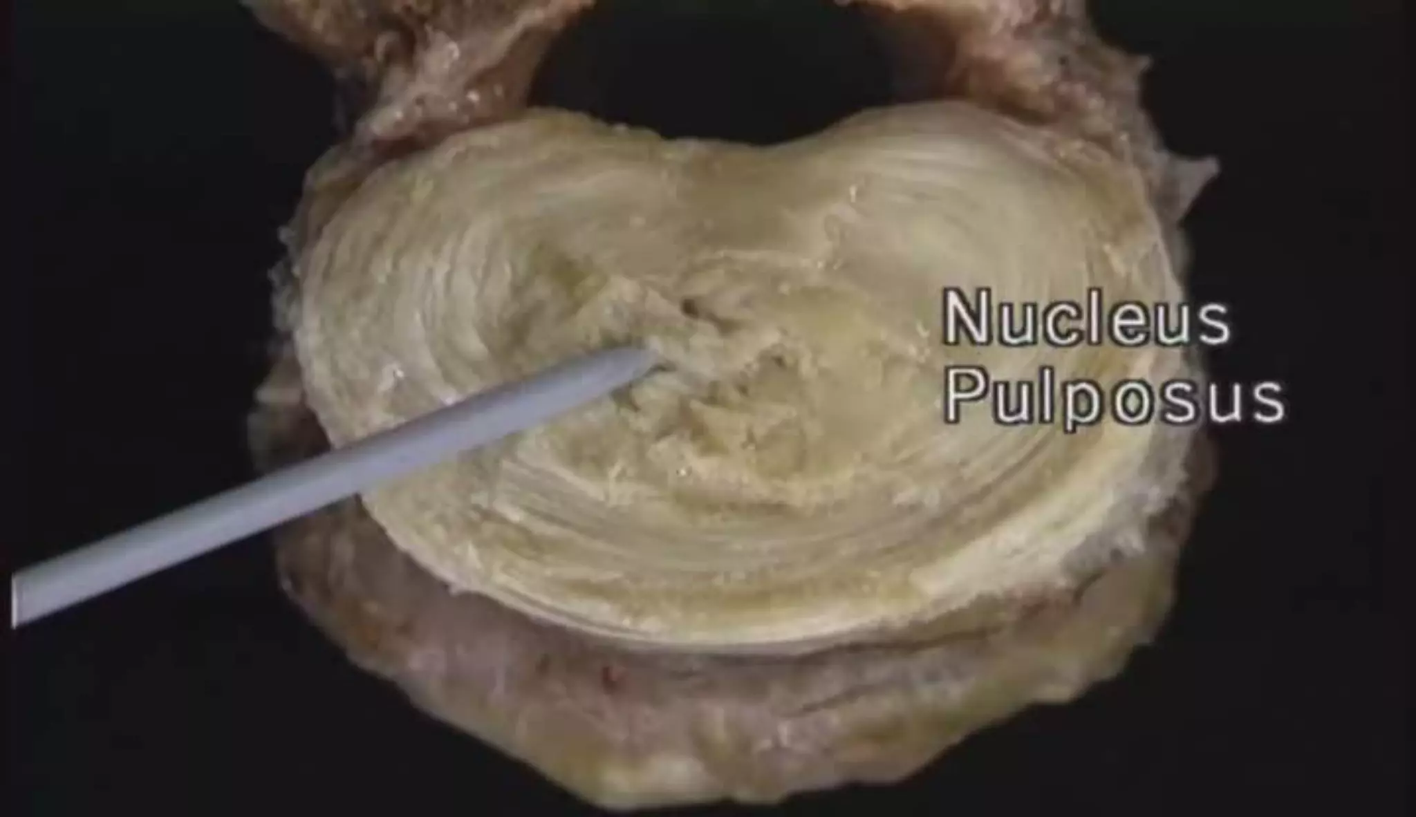 Intervertebral disc prolapse(ivdp) | PPTX