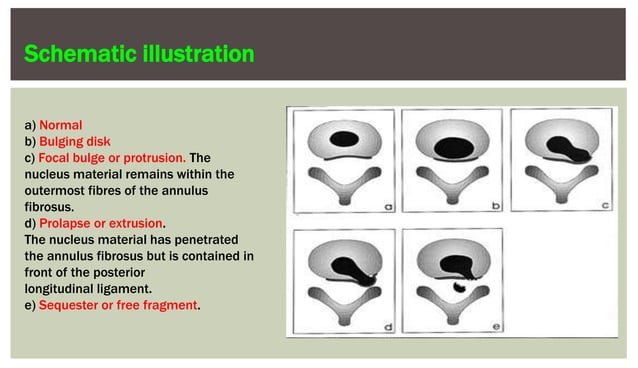 Intervertebral disc prolapse(ivdp) | PPTX | Bone and Joint Conditions ...