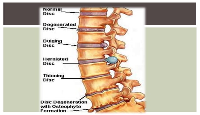 Intervertebral disc prolapse(ivdp) | PPTX | Bone and Joint Conditions ...