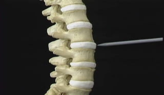 Intervertebral disc prolapse(ivdp) | PPTX