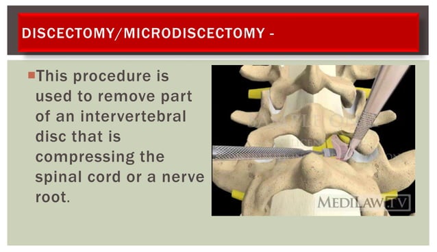 Intervertebral disc prolapse(ivdp) | PPTX | Bone and Joint Conditions ...