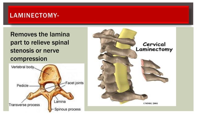 Intervertebral disc prolapse(ivdp) | PPTX | Bone and Joint Conditions ...