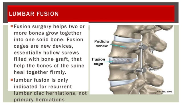 Intervertebral disc prolapse(ivdp) | PPTX | Bone and Joint Conditions ...