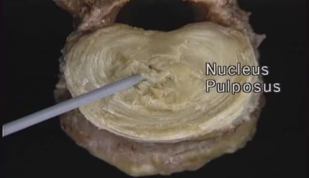 Intervertebral disc prolapse(ivdp) | PPTX | Bone and Joint Conditions ...