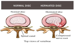 Intervertebral Disc Prolapse