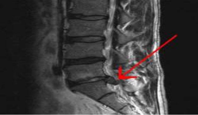 Intervertebral disc prolapse(ivdp)