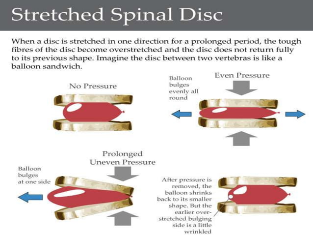 Intervertibral disc prolapse | PPTX