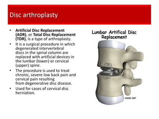 Intervertibral disc prolapse | PPTX