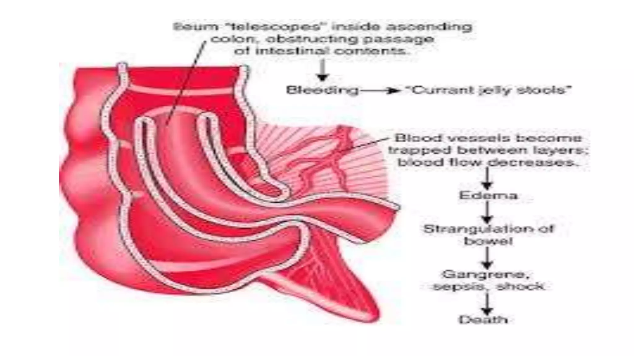 Intessuception in children | PPT