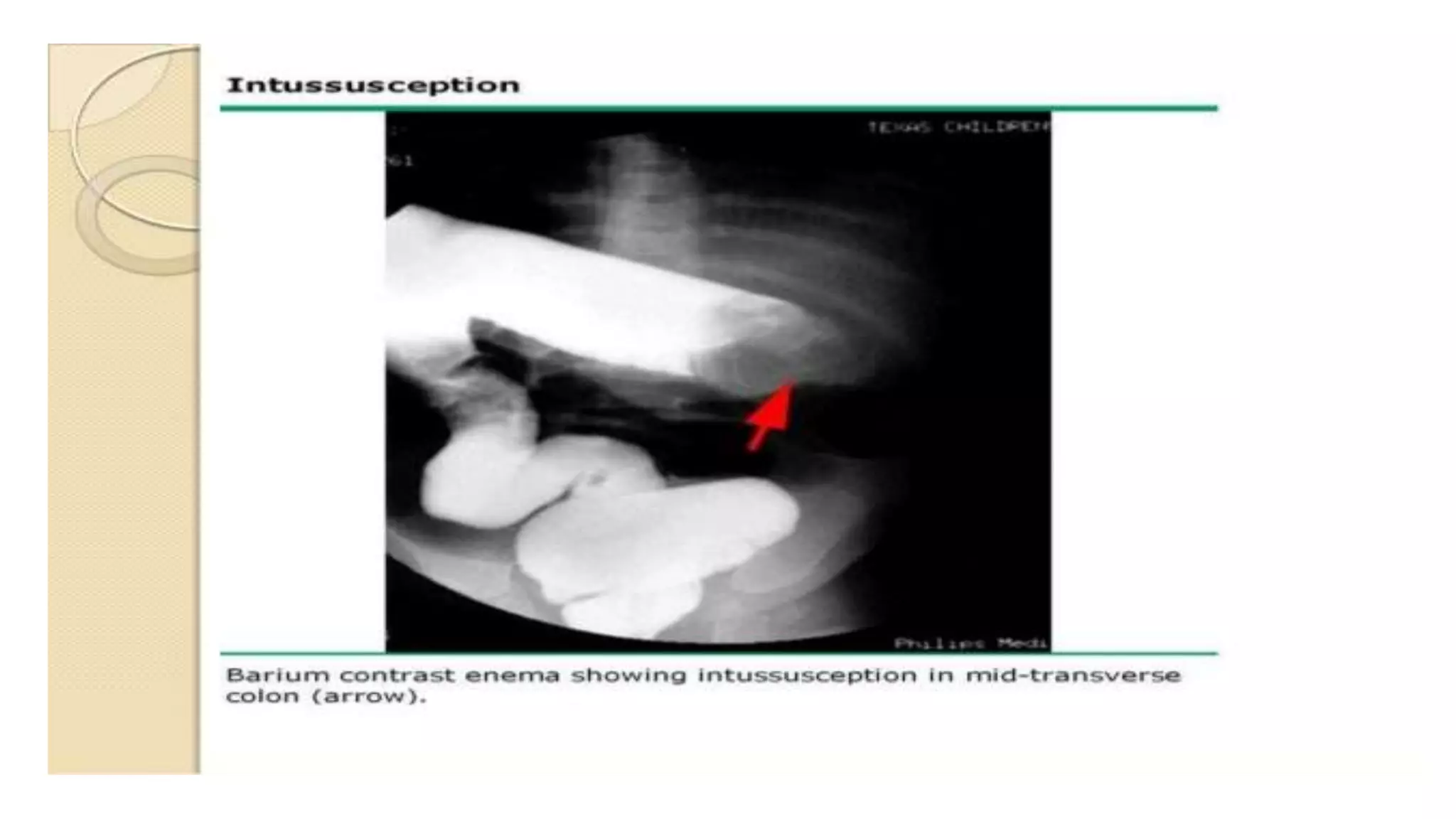 Intessuception in children | PPT