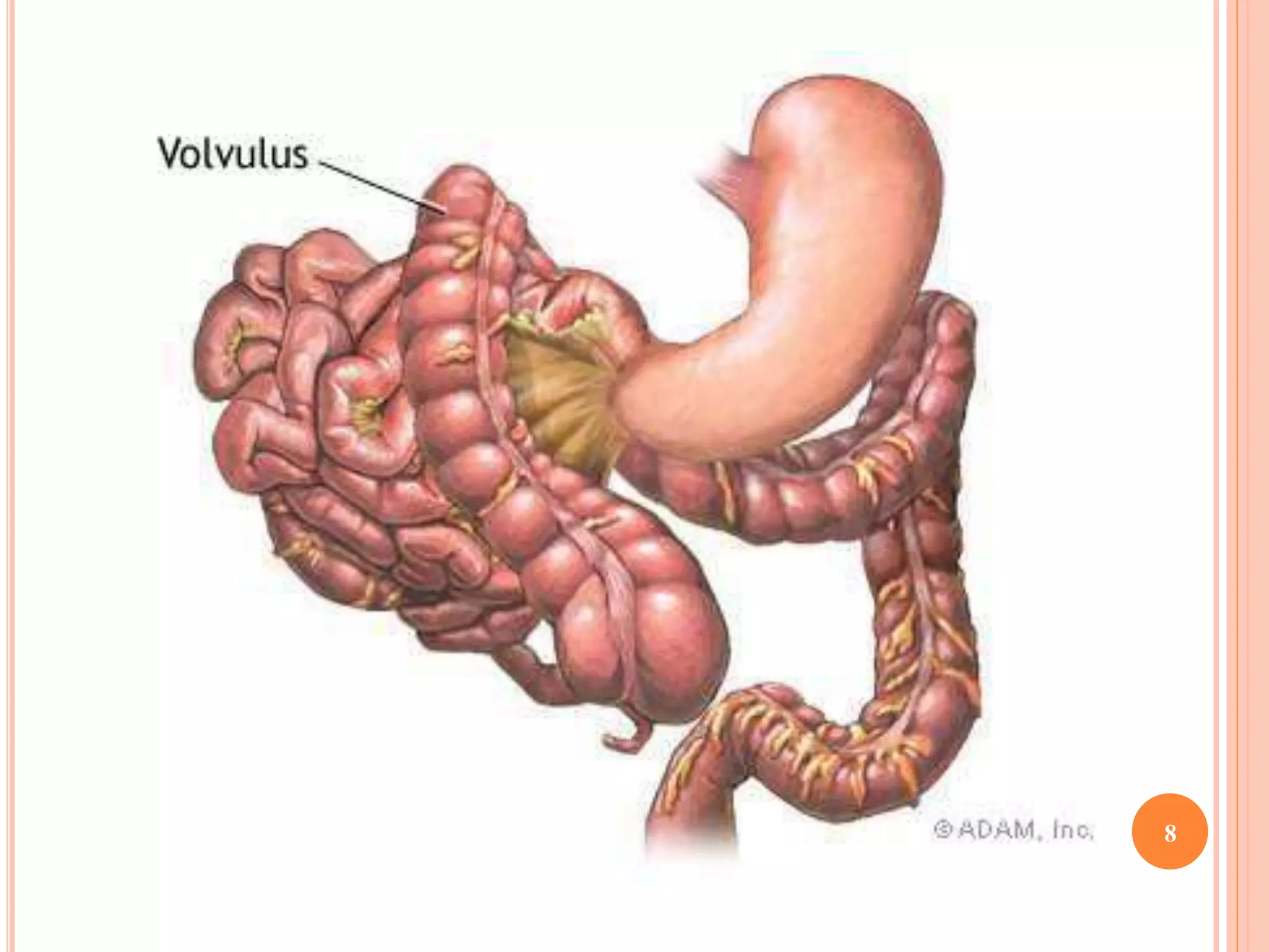 Intestinal obstruction | PPTX | Digestive Disorders | Diseases and ...