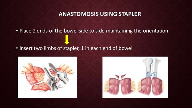 Intestinal anastomosis and staplers