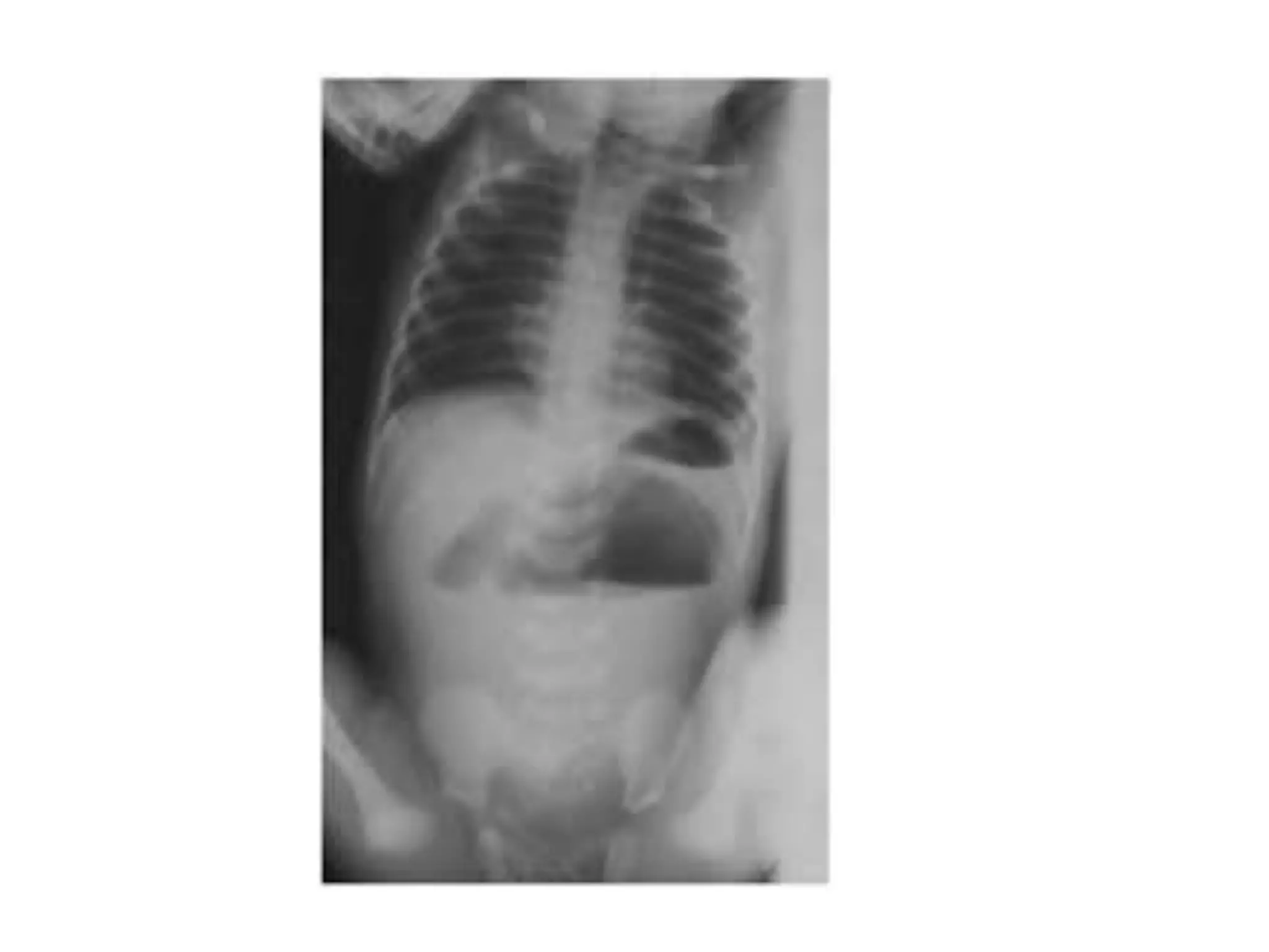 Intestinal atresia | PPTX