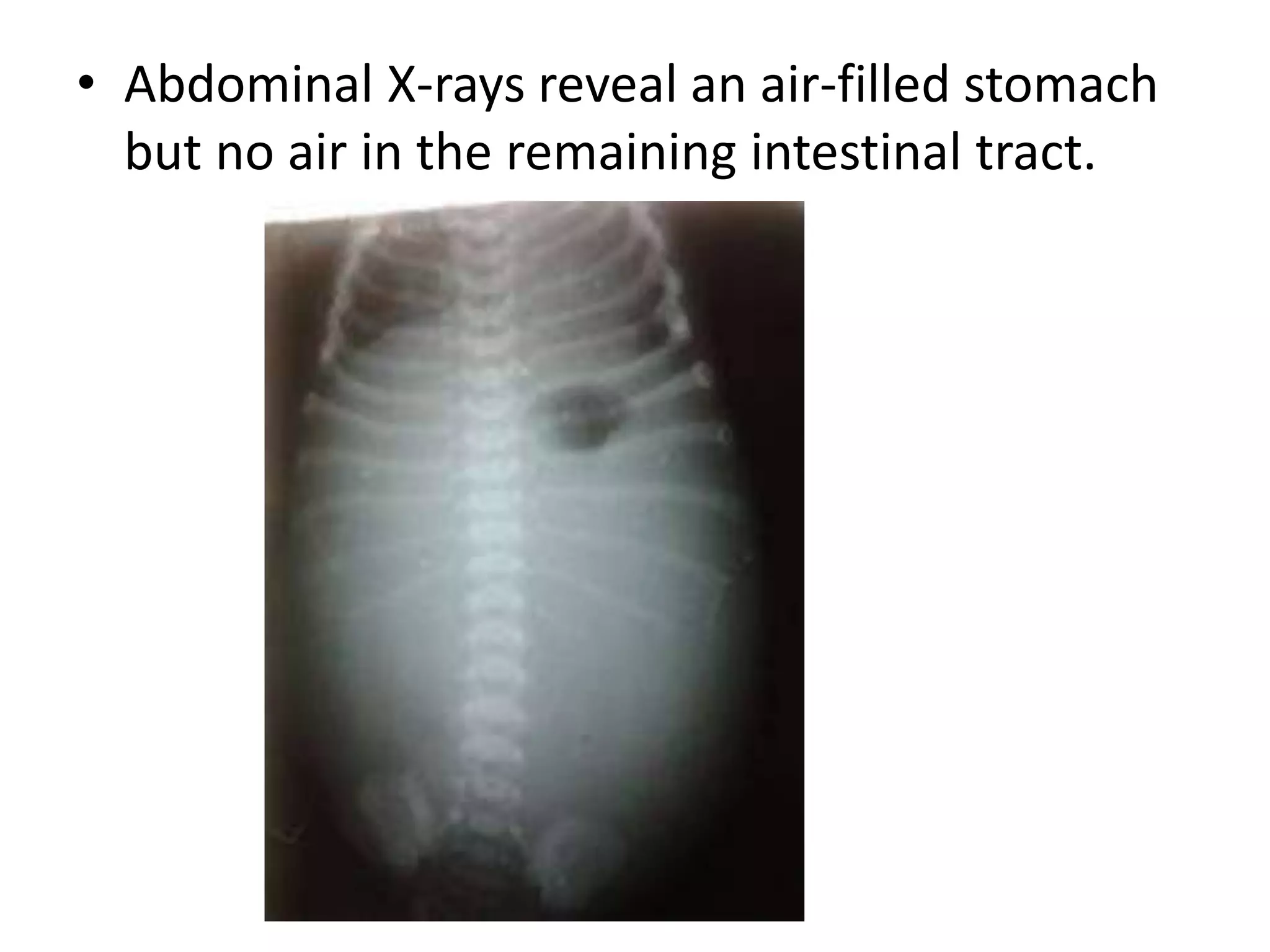 Intestinal atresia | PPTX