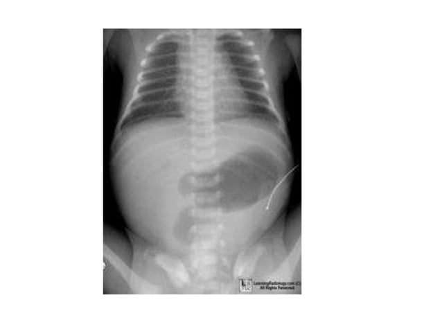 Intestinal atresia | PPTX | Pregnancy | Reproductive Health