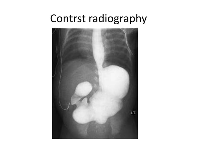 Intestinal atresia | PPTX | Pregnancy | Reproductive Health
