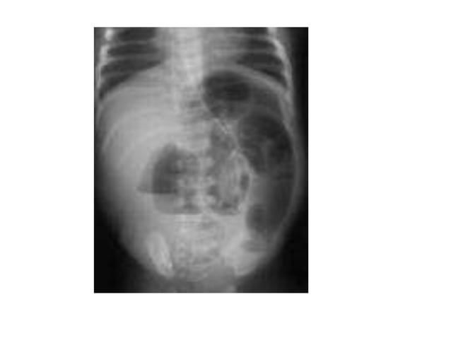 Intestinal atresia | PPTX | Pregnancy | Reproductive Health