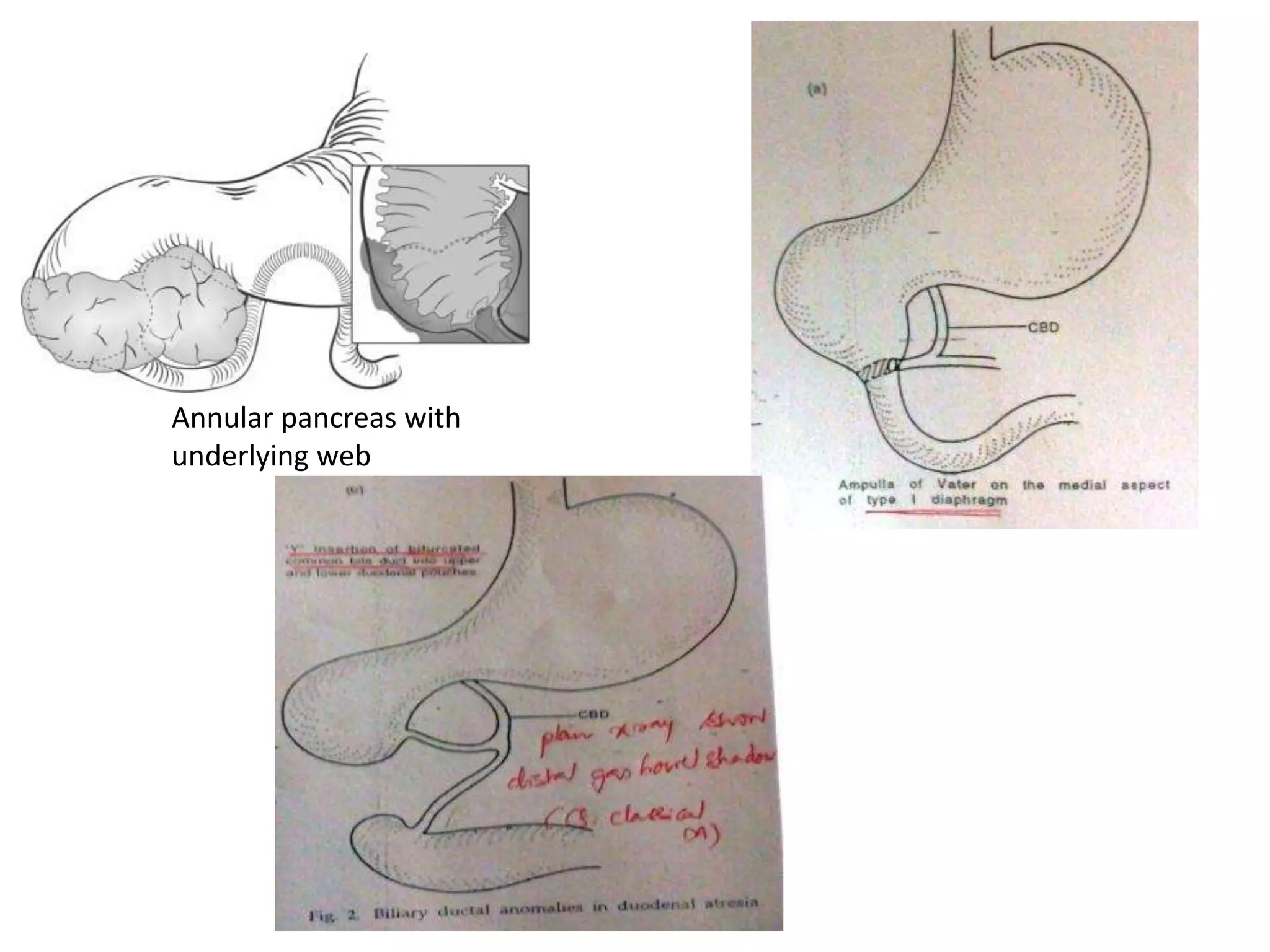 Intestinal atresia and meconium ileus | PPTX