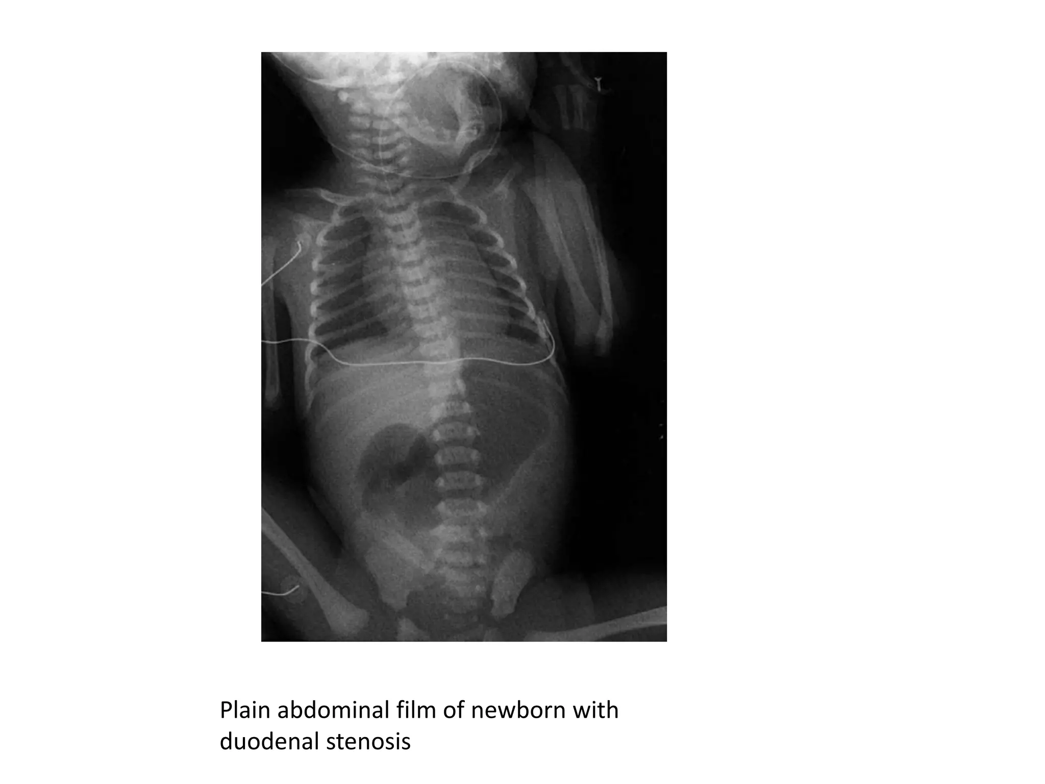 Intestinal atresia and meconium ileus | PPTX