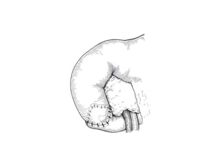 Intestinal atresia and meconium ileus | PPTX