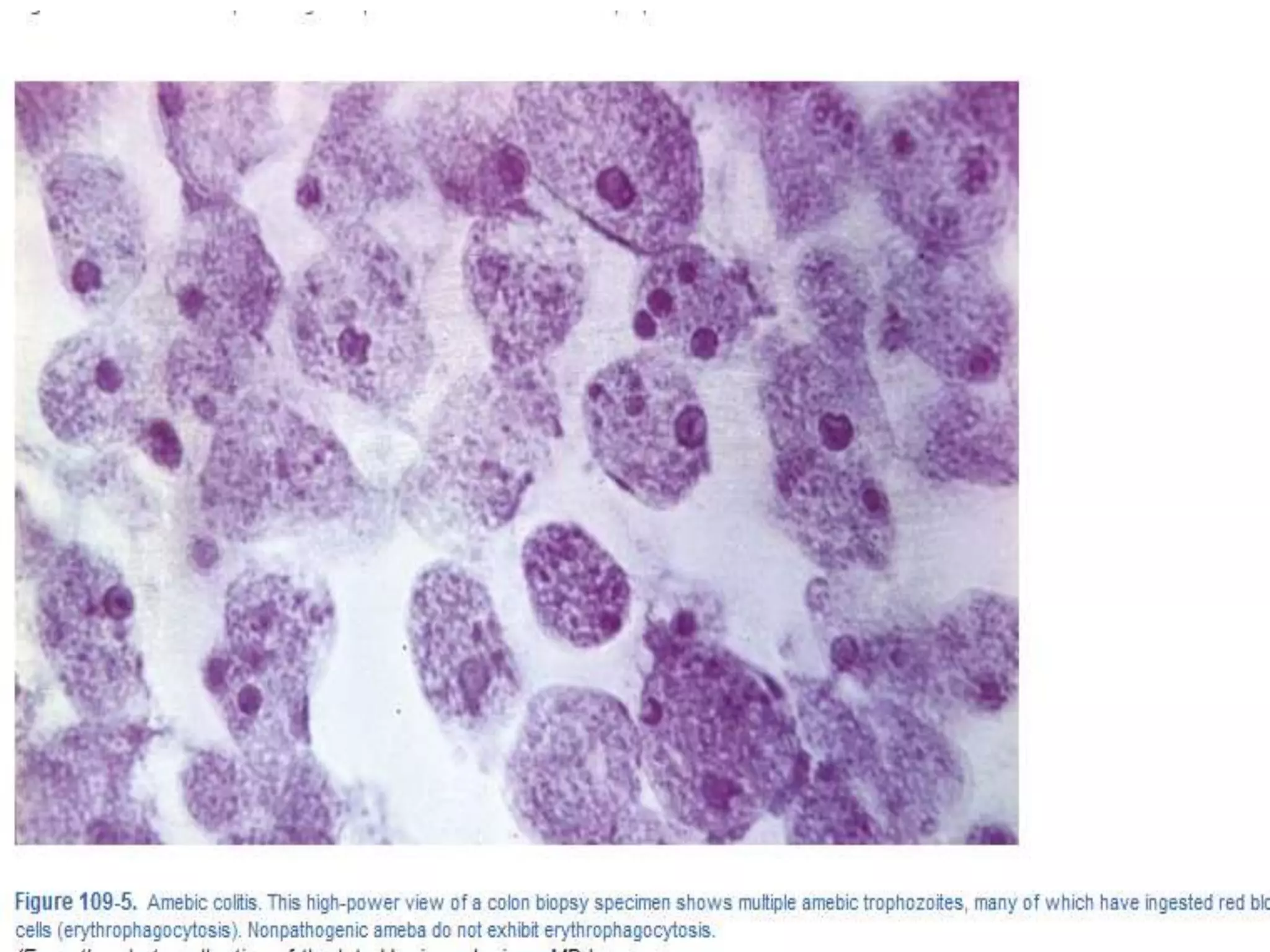 Intestinal Entamoeba histolytica amebiasis - Copy.ppt