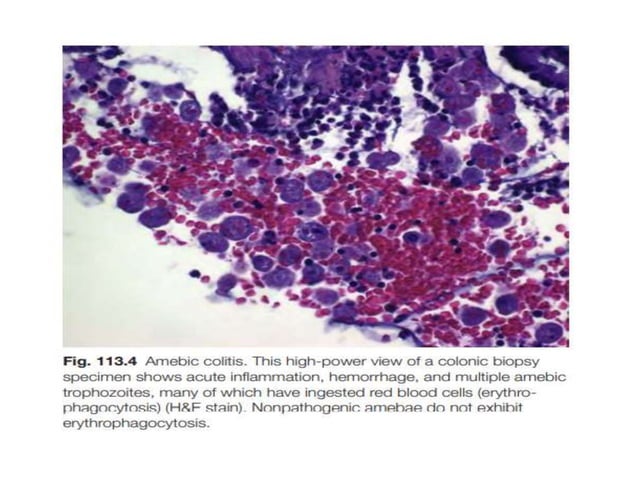 Intestinal Entamoeba histolytica amebiasis - Copy.ppt