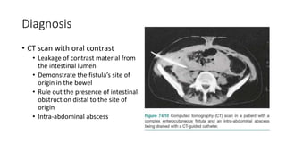 Intestinal Fistula (general surgery).pptx