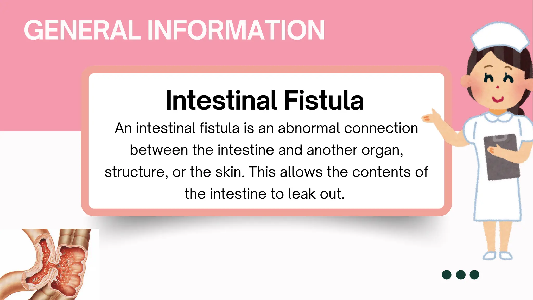 Intestinal Fistula.pdf health allied.com