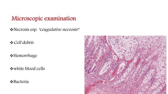 Intestinal gangrene | PPTX