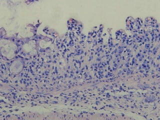 Intestinal injury | PPTX