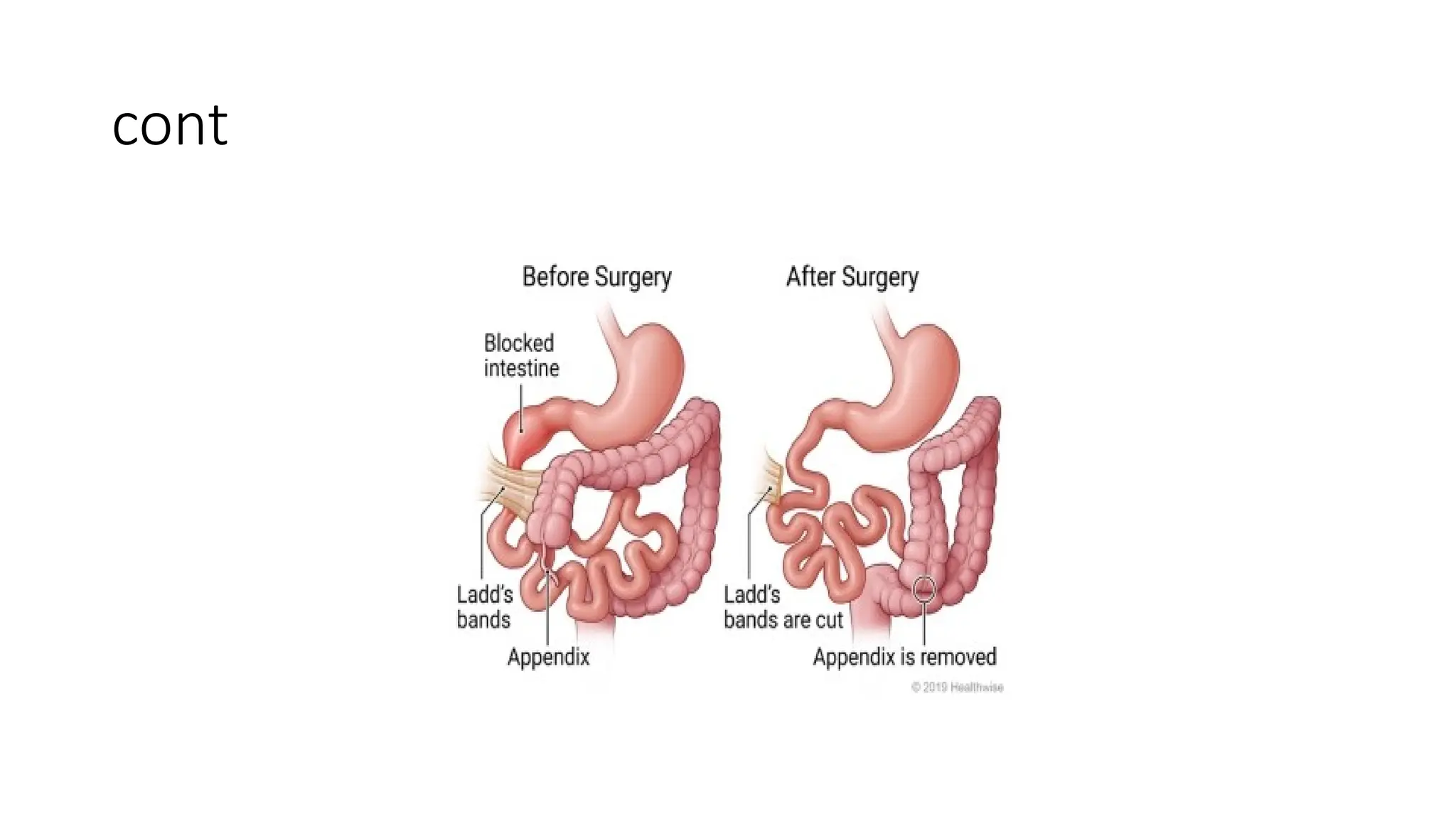 INTESTINAL MALROTATION EXPLAINED; spot the signs before a Medical ...