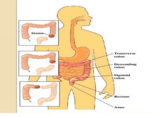 intestinal obstruction. B.Sc Nursing 2 year digestive system | PPTX