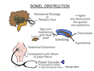 intestinal obstruction. B.Sc Nursing 2 year digestive system | PPTX