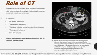 small intestinal obstruction | PPT