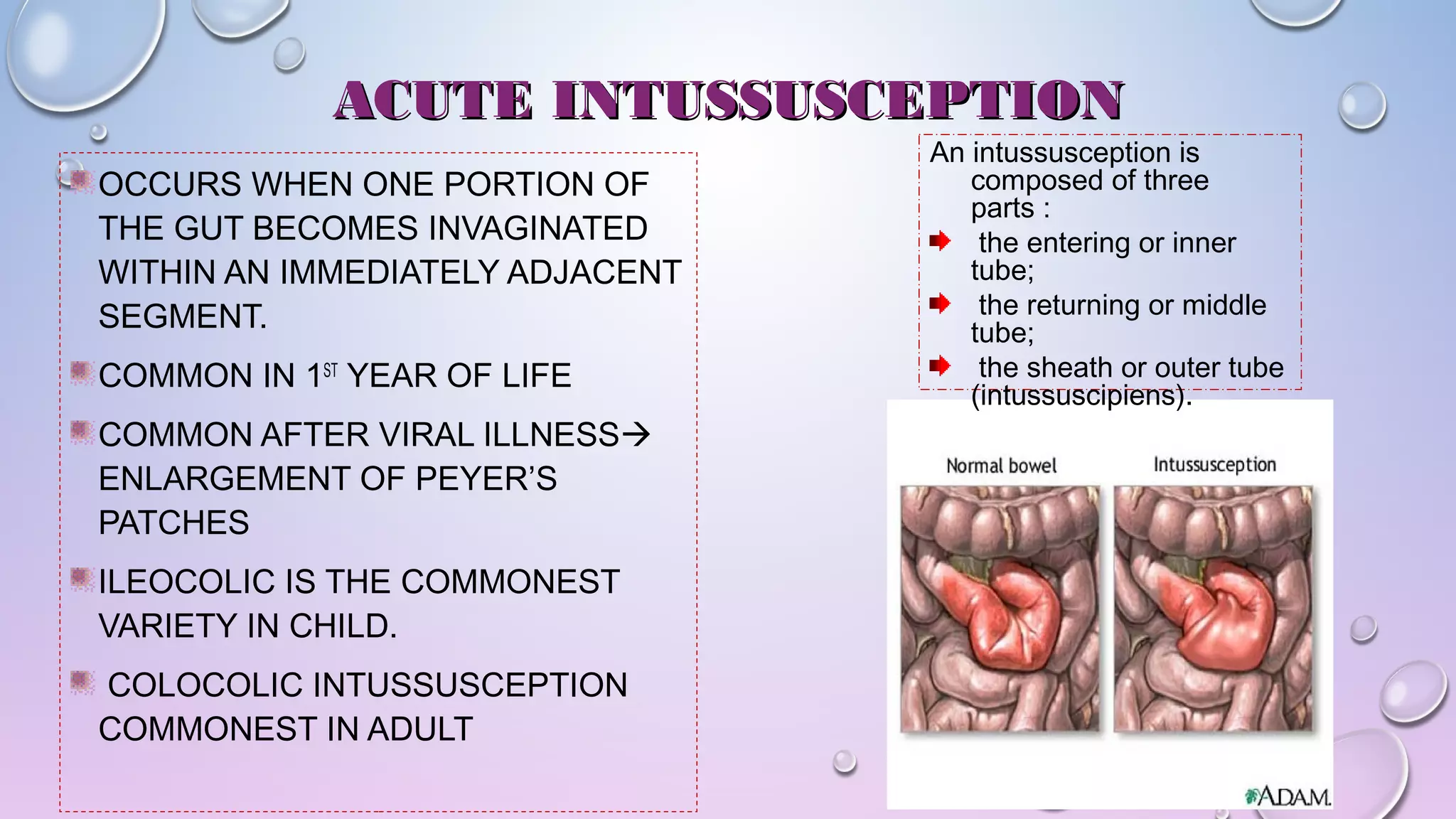 Intestinal obstruction | PPT