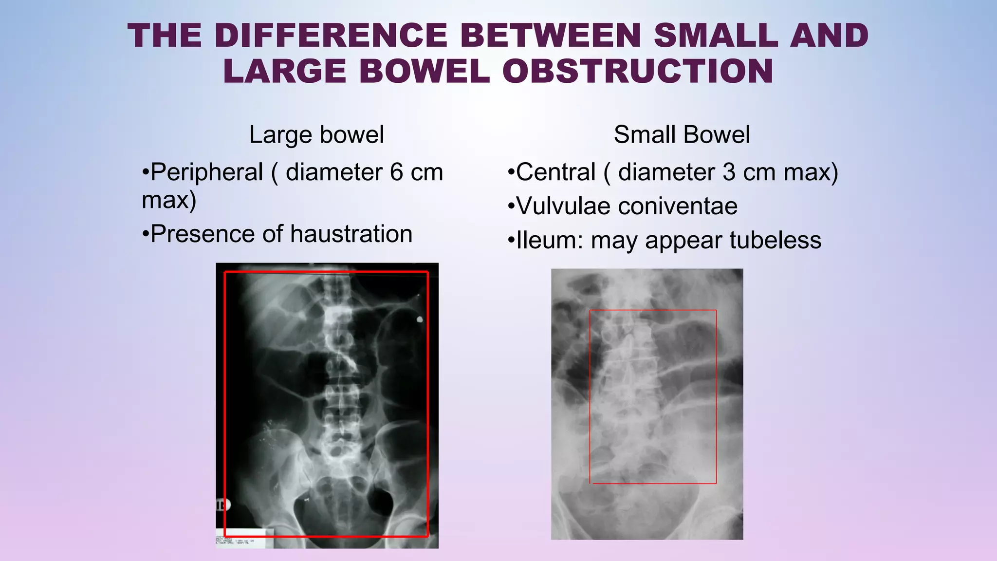 Intestinal obstruction | PPT | Digestive Disorders | Diseases and ...
