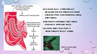 Intestinal obstruction | PPT